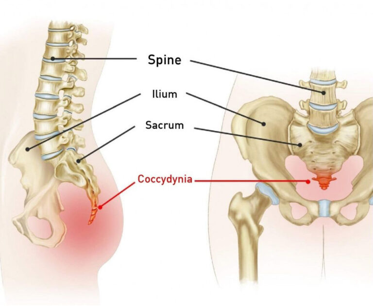 Tail Bone Pain Advino Curalaser